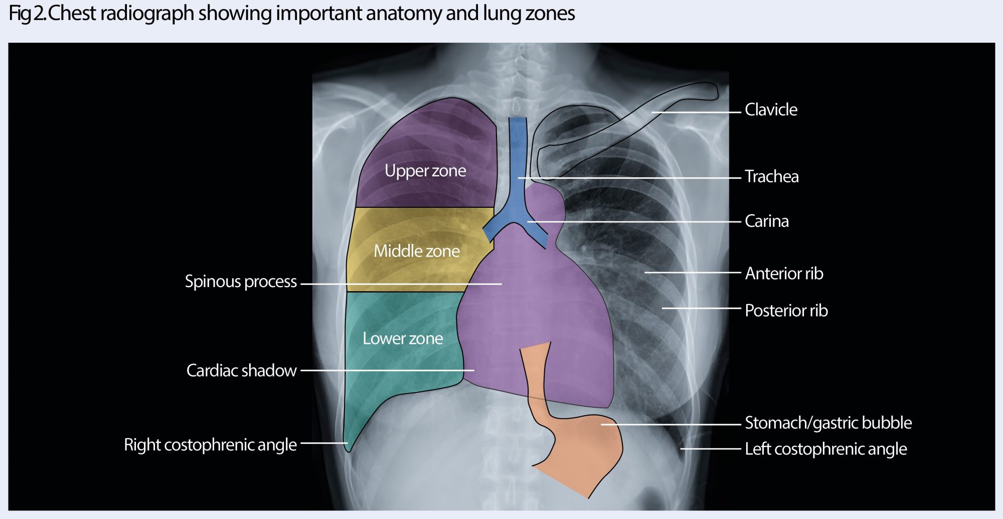 How to interpret chest radiographs (X-rays): a systematic approach | Nursing Times