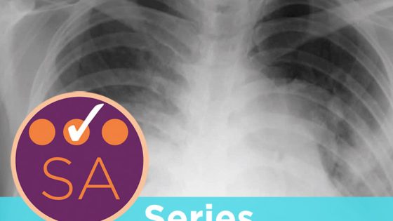 How to interpret chest radiographs (X-rays): a systematic approach ...