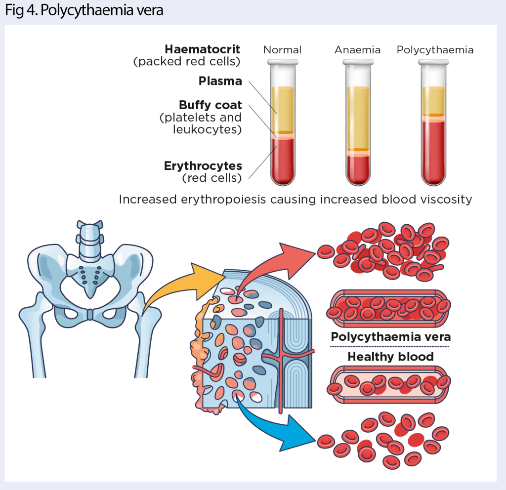Understanding leukaemia: risk factors, symptoms and treatment | Nursing ...