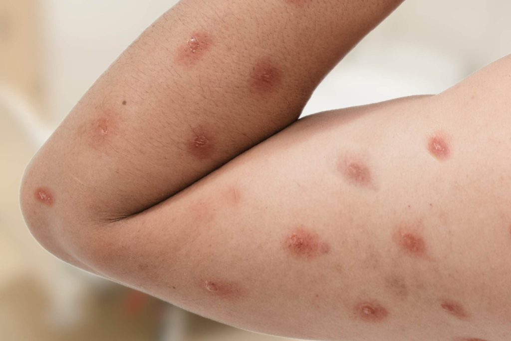 First case of new severe mpox strain detected in England | Nursing Times