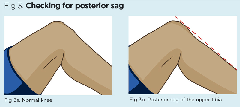 Assessment and management of knee pain: taking a holistic approach ...