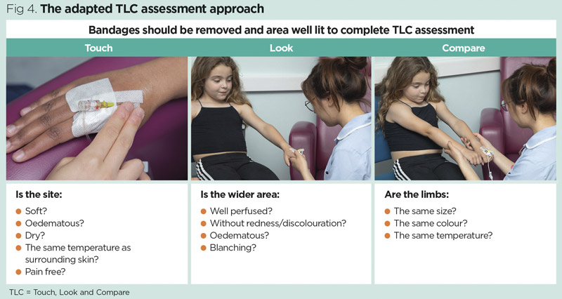 Reducing harm of extravasations in IV medicine administration | Nursing ...