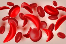 'Functional cure' for sickle cell disease now offered on NHS | Nursing ...