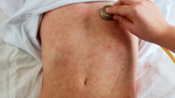 Measles: factsheet on nursing childhood infectious diseases | Nursing Times