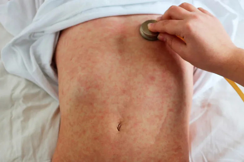 Measles: factsheet on nursing childhood infectious diseases | Nursing Times