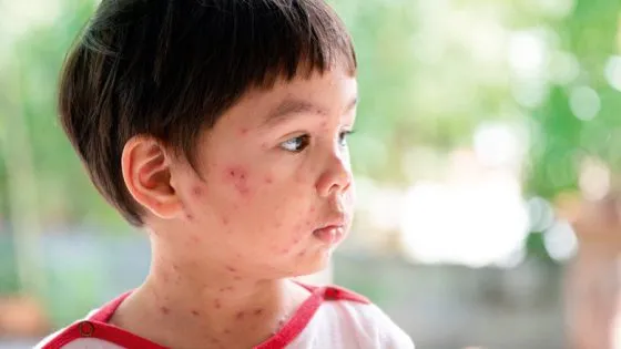 Chickenpox: factsheet on nursing childhood infectious diseases ...