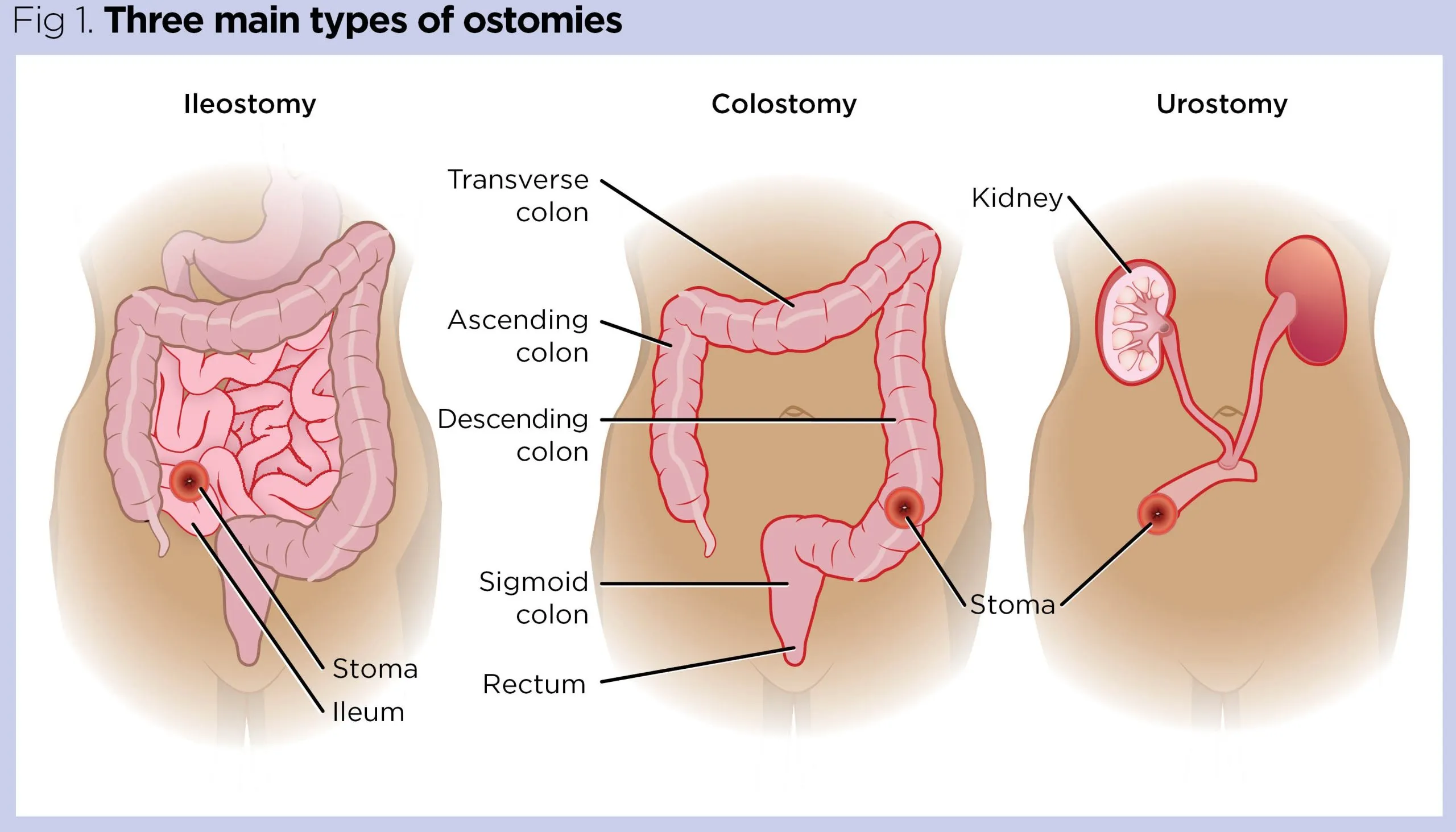 Understanding the basics of stoma care and how to recognise complications | Nursing Times