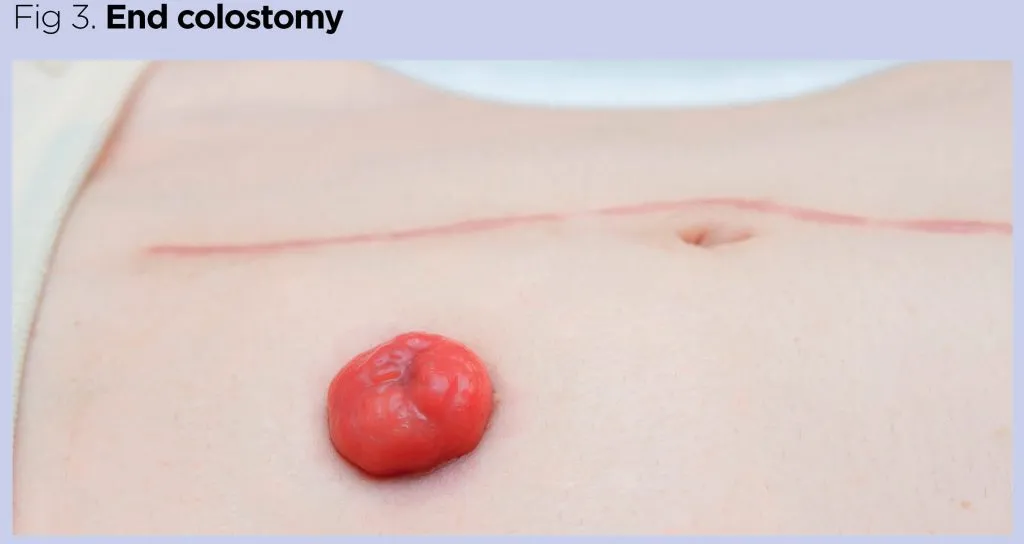Understanding the basics of stoma care and how to recognise ...