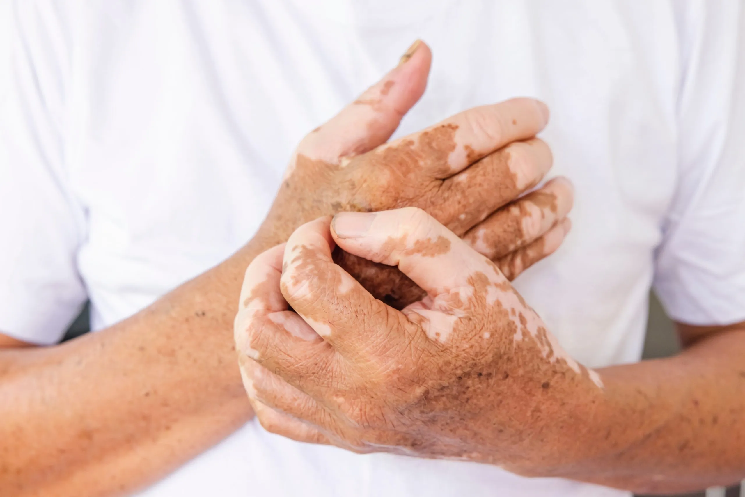 First treatment for devastating skin condition backed by NICE for NHS ...